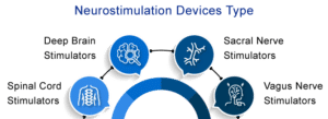 Neurostimulation Devices for Chronic Pain | Market Trends and Outlook