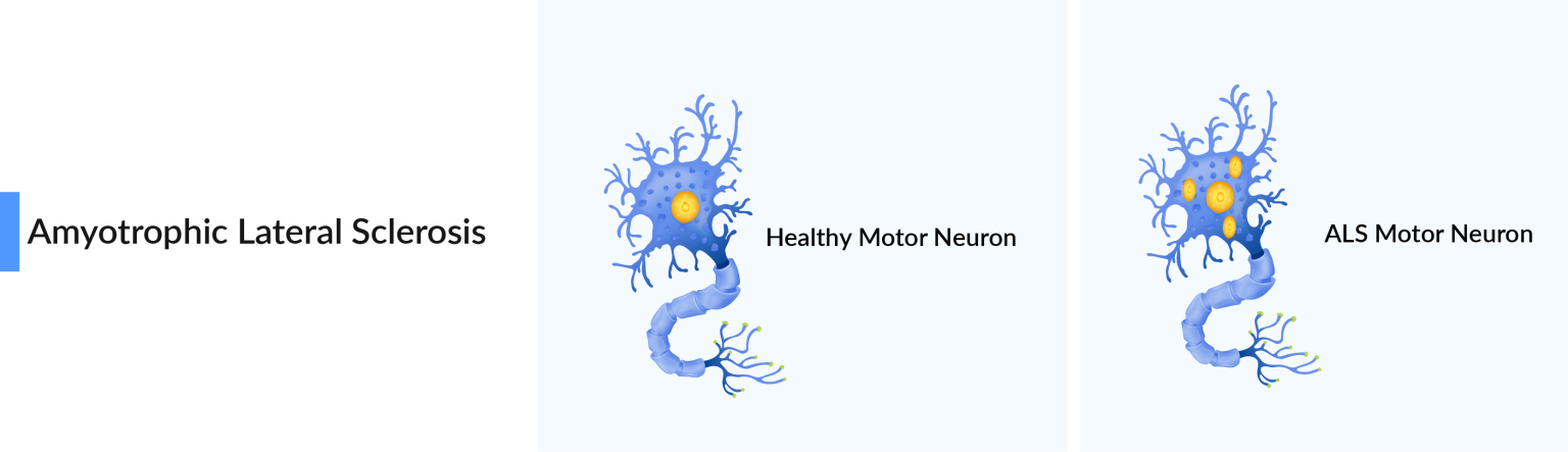 How Does Radicava Work for Amyotrophic Lateral Sclerosis?